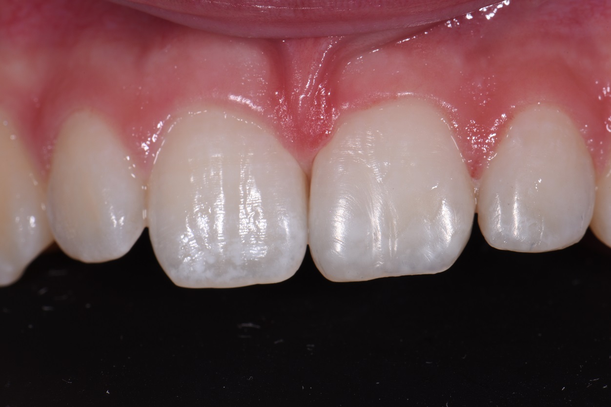 Tooth Fracture Repair | ACC New Zealand | Tam Dental Group