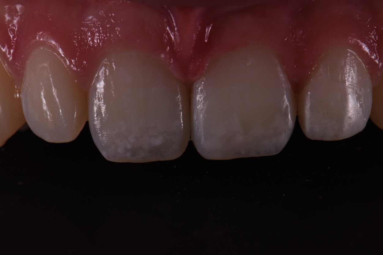 Tooth Fracturecracked Tooth Causes Diagnosis And Treatments