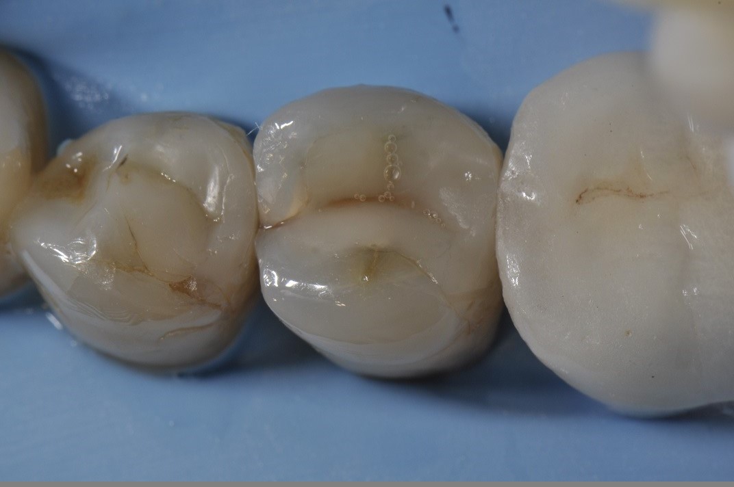 Large Cavities and Invisible Fillings | Cosmetic Dentistry Auckland