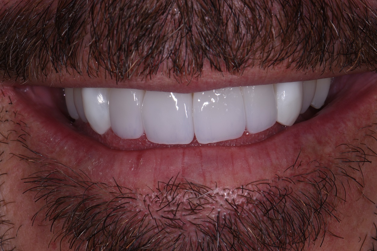 Fixing Other Dentist s Veneers Ghost Teeth No More fixing-other-dentist-s-veneers-ghost-teeth-no-more
