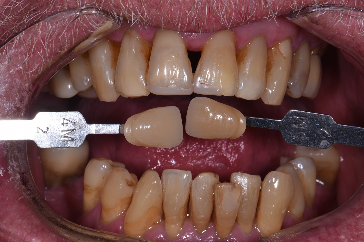 The Godfather Esthetic Solution: Custom Bleaching Trays The Godfather Esthetic Solution: Custom Bleaching Trays