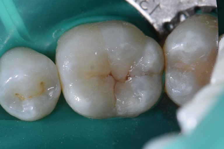 Amalgam Staining Removal | Restorative Dentistry Excellence