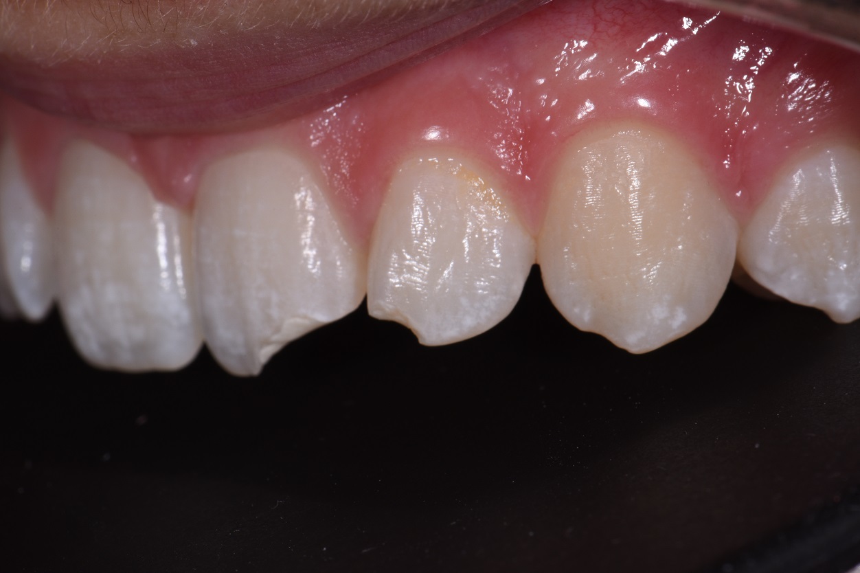 Tooth Fracture Repair | ACC New Zealand | Tam Dental Group