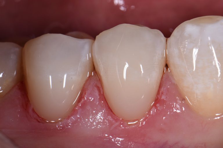 Tooth Neck Wear | Restoring Toothbrush Abrasion