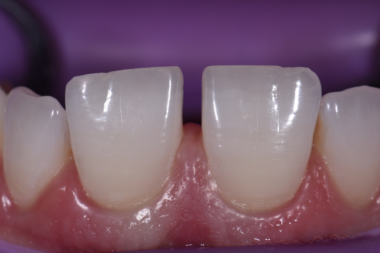 Closing Gaps Between Teeth | Digital Smile Design | AACD Cosmetic ...
