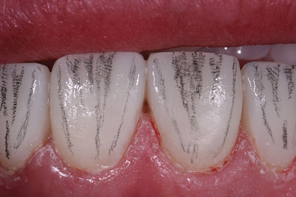 Closing Gaps Between Teeth | Digital Smile Design | AACD Cosmetic ...