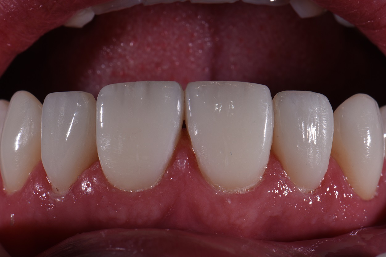 Closing Gaps Between Teeth | Digital Smile Design | AACD Cosmetic ...