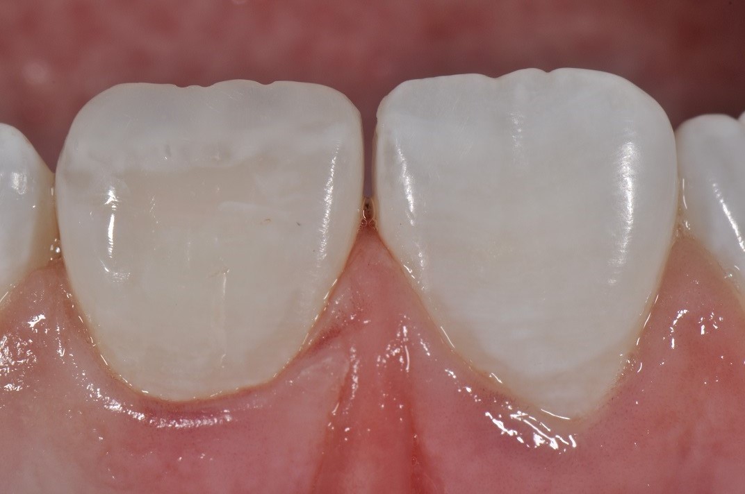 Restoring Teeth with Character | Cosmetic Dentist Auckland