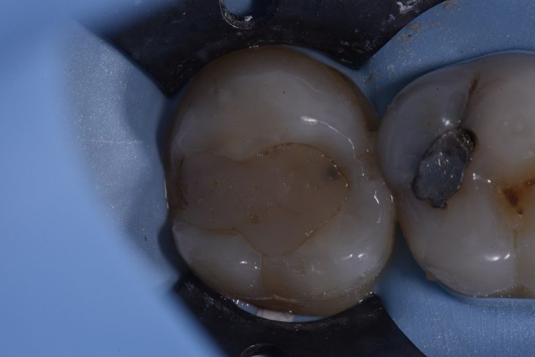 Replacing Old Composite Fillings | Posterior Composite Fillings | Resin ...