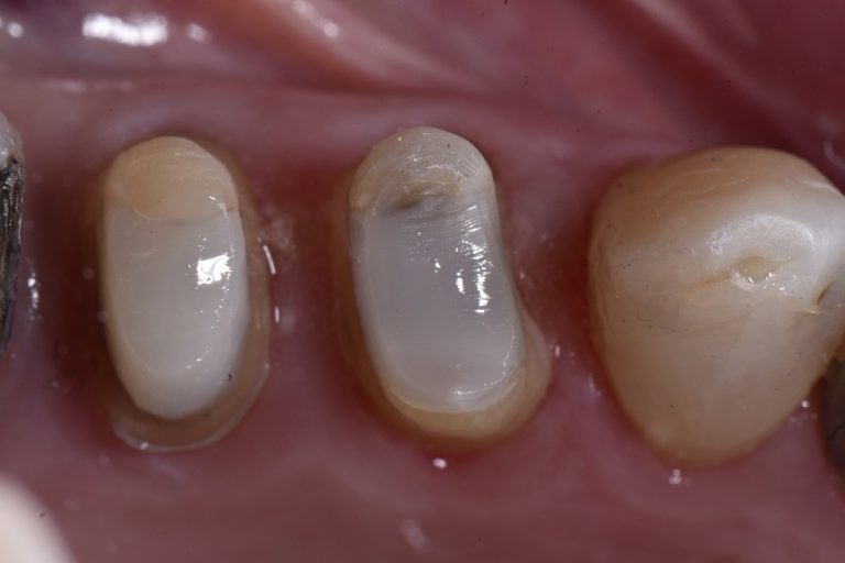 Mercury Removal | Amalgam Free | Minimal Invasive Crown Preparation ...