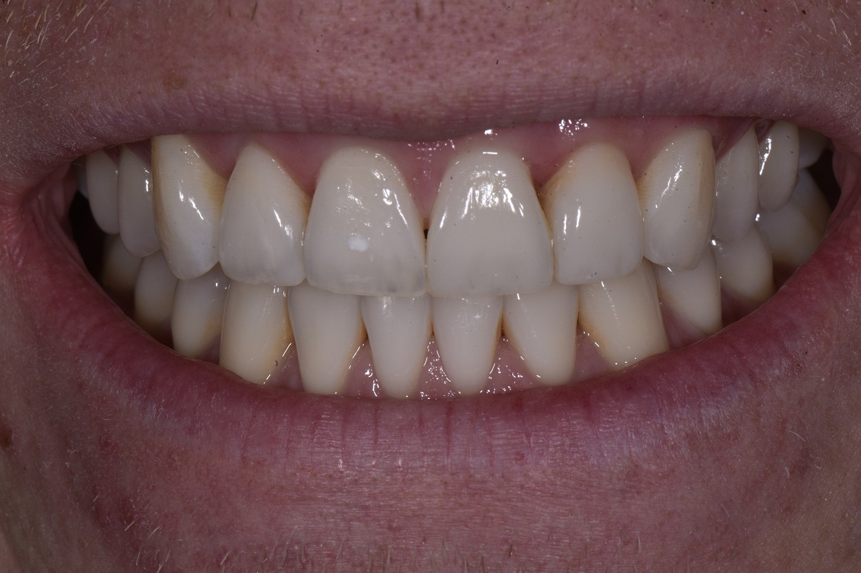 Invisalign | Braces | Bleach | Bonding | Minimally Invasive Cosmetic ...