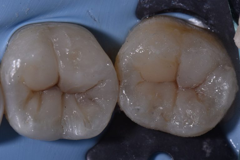 Replacing Leaking Fillings | Tooth Contoured Fillings | Restorative ...