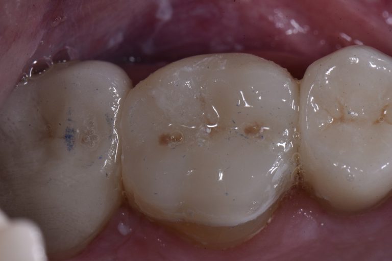 Conservative Dental Crown | Enamel Preservation | Restorative Dentistry ...