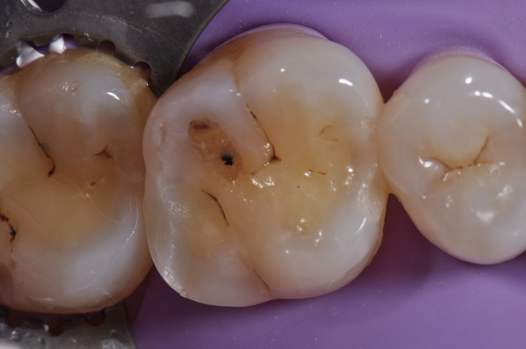 Replacement of Old Fillings | Restorative Dentistry