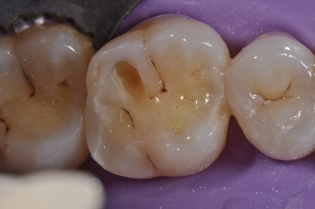 Replacement of Old Fillings | Restorative Dentistry