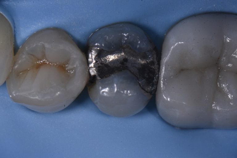 Amalgam Replacement | Cosmetic Dentist Auckland