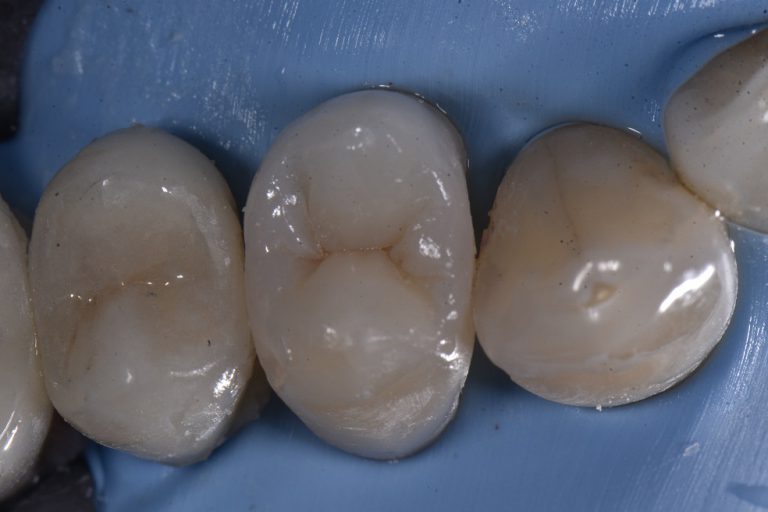 Restoring Teeth to Mimic Nature | Biomimetic Dentistry Auckland