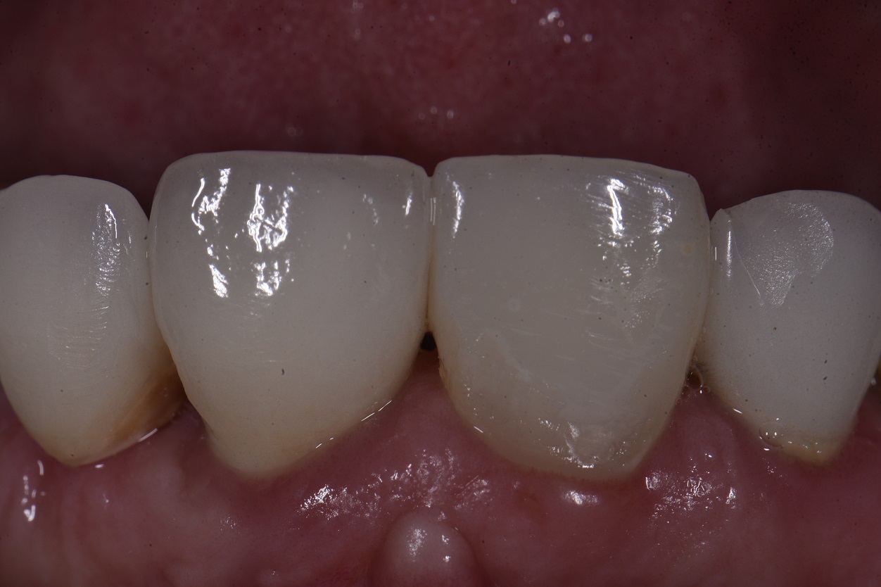 Tissue Emergence Profile Around Implants | Precision Cosmetic Dentistry ...