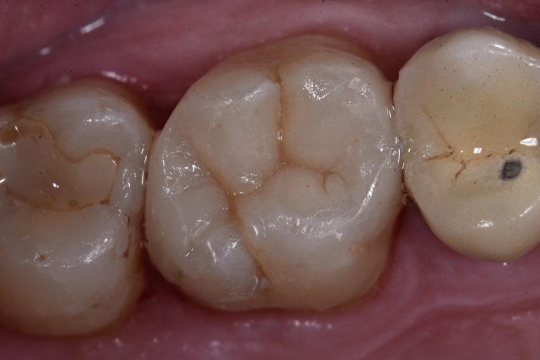 Dental Cavities | White Fillings | Dental Excellence Auckland