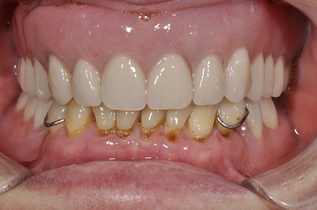 Redesigning Complex Bites | Occlusion | Restorative Dentistry