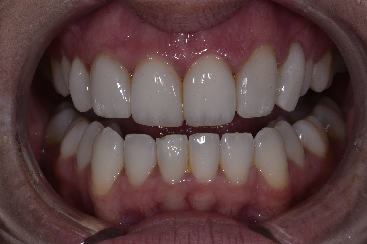 Correction of Missing Lateral Incisors Using Digital Smile Design ...