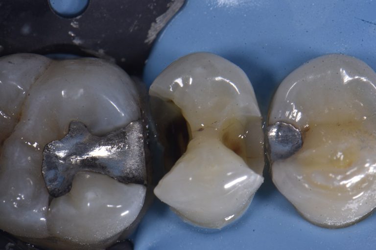Large Amalgam Replacements | Restorative Dentist Auckland