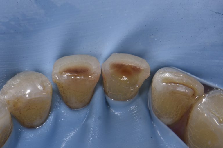 Modification of the Envelope of Function for Increased Restorative ...
