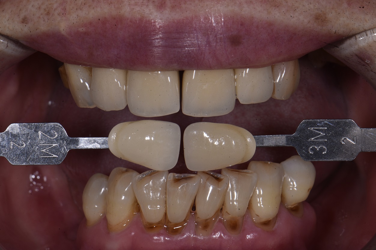 Kois Deprogrammer and OVD setup for dental rehabilitation