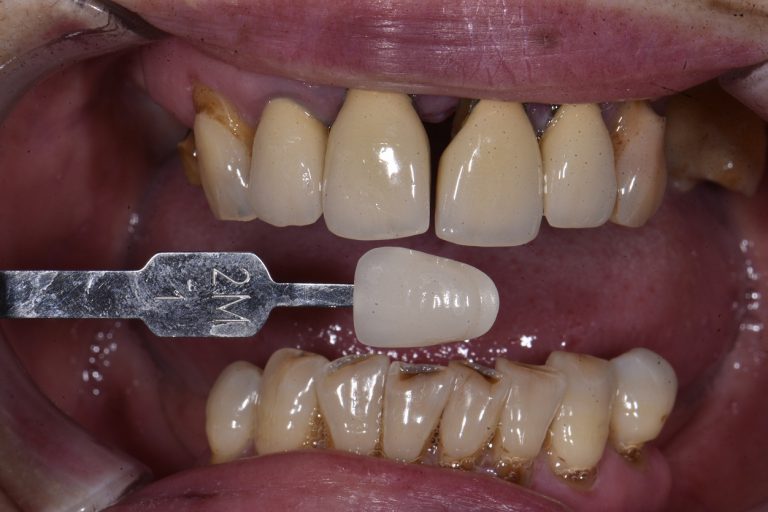 Kois Deprogrammer and OVD setup for dental rehabilitation