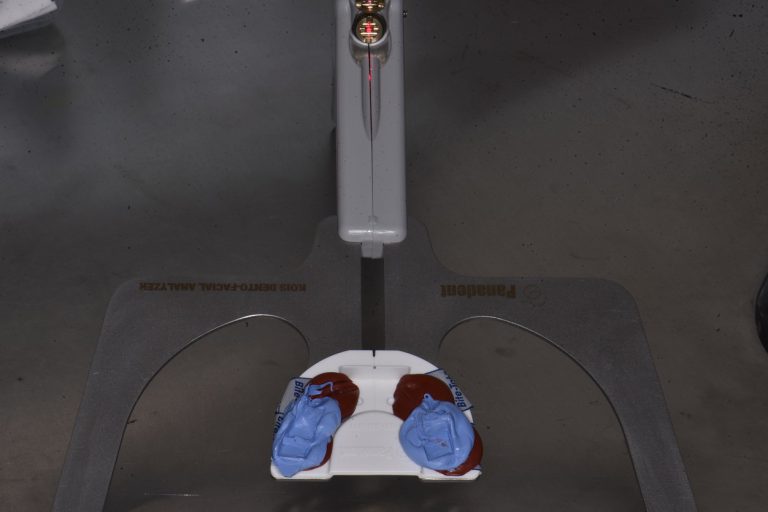 Kois Deprogrammer and OVD setup for dental rehabilitation