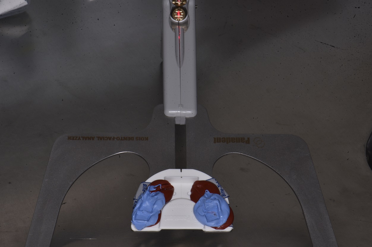 Kois Deprogrammer and OVD setup for dental rehabilitation