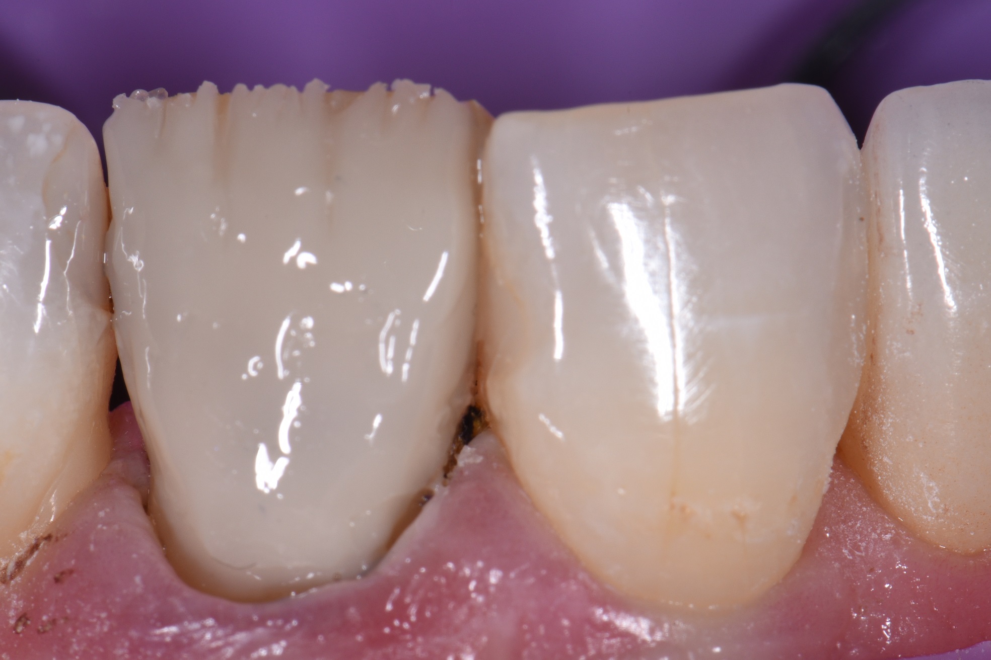 Lightening a dark tooth with composite resin artistry