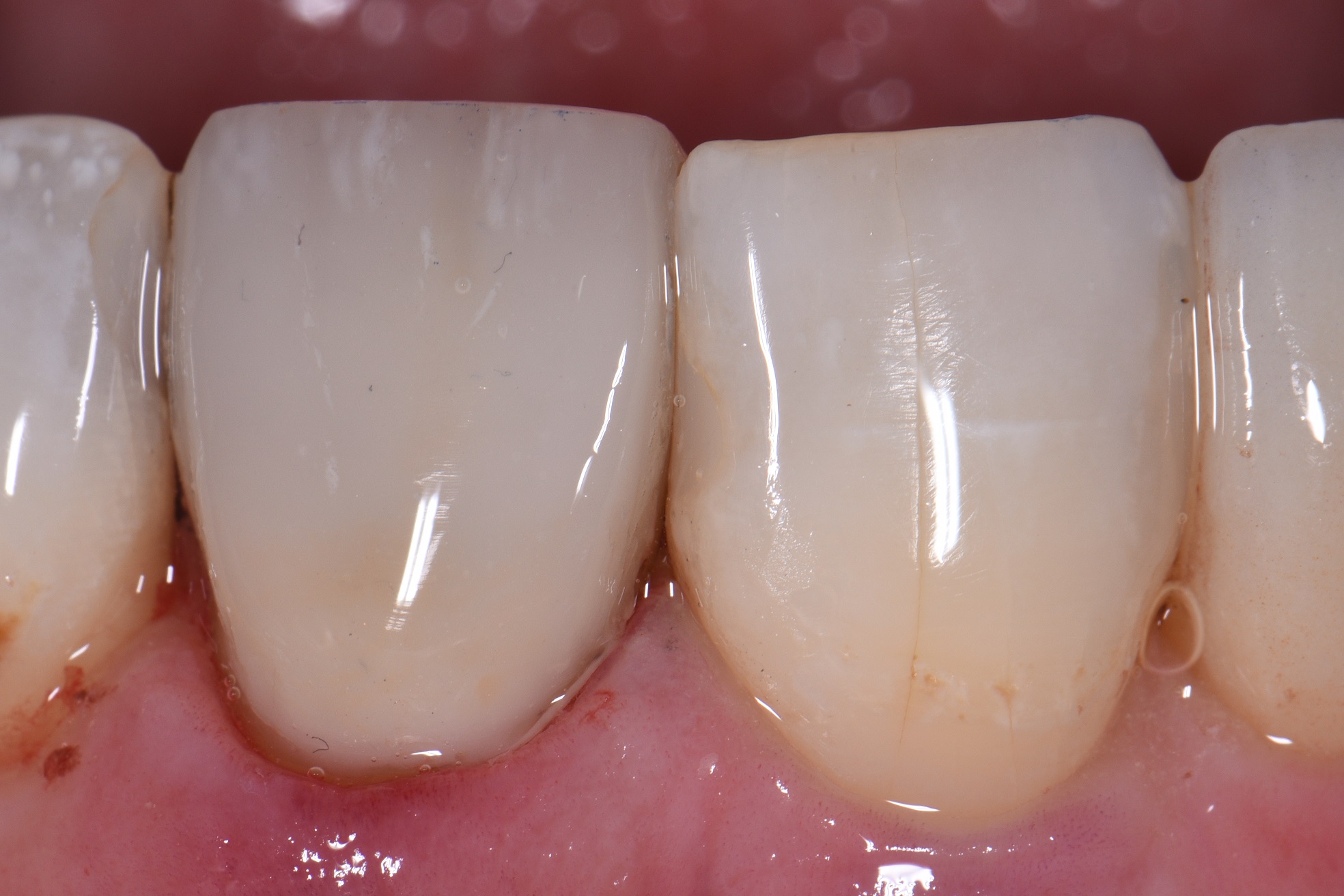 Lightening a dark tooth with composite resin artistry