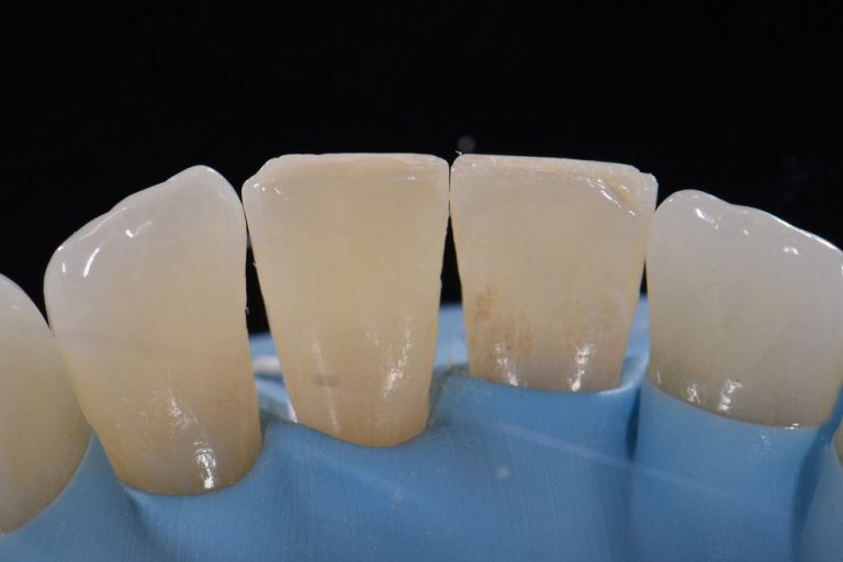 Small Enamel Fracture Repairs | Cosmetic Dentist Auckland