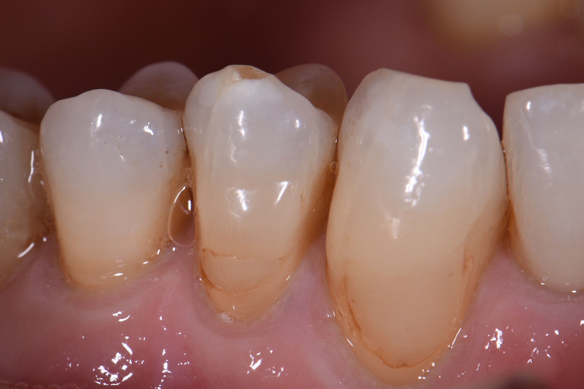 Well blended Composite Resin | Cosmetic Fillings