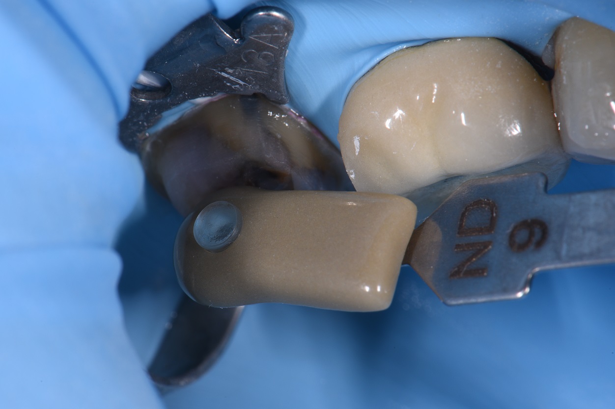 Biomimetic Dentistry | Crowns that look like teeth