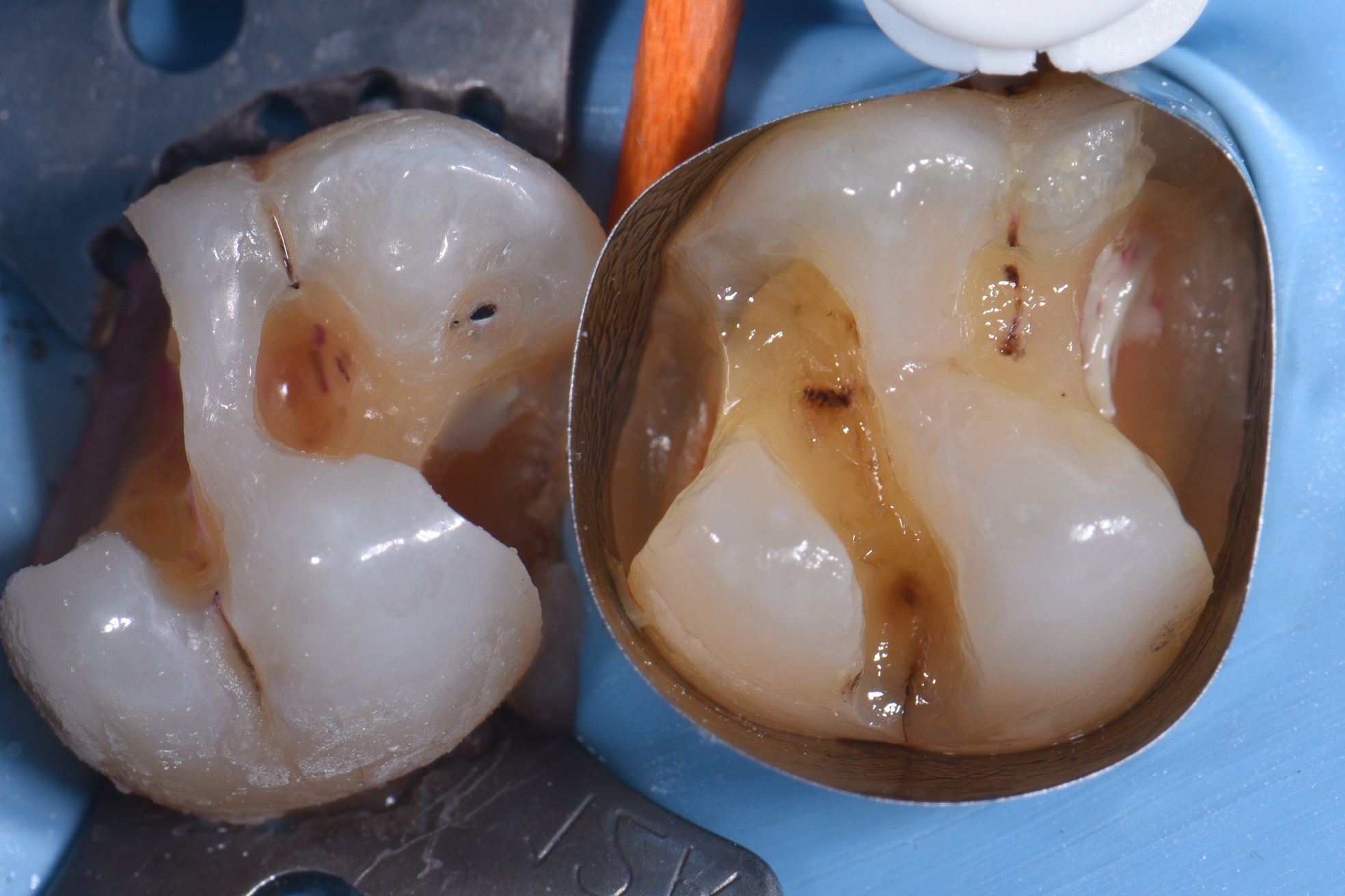 Large Fillings | Sculpted Composite Resin Artistry | Auckland Dentist