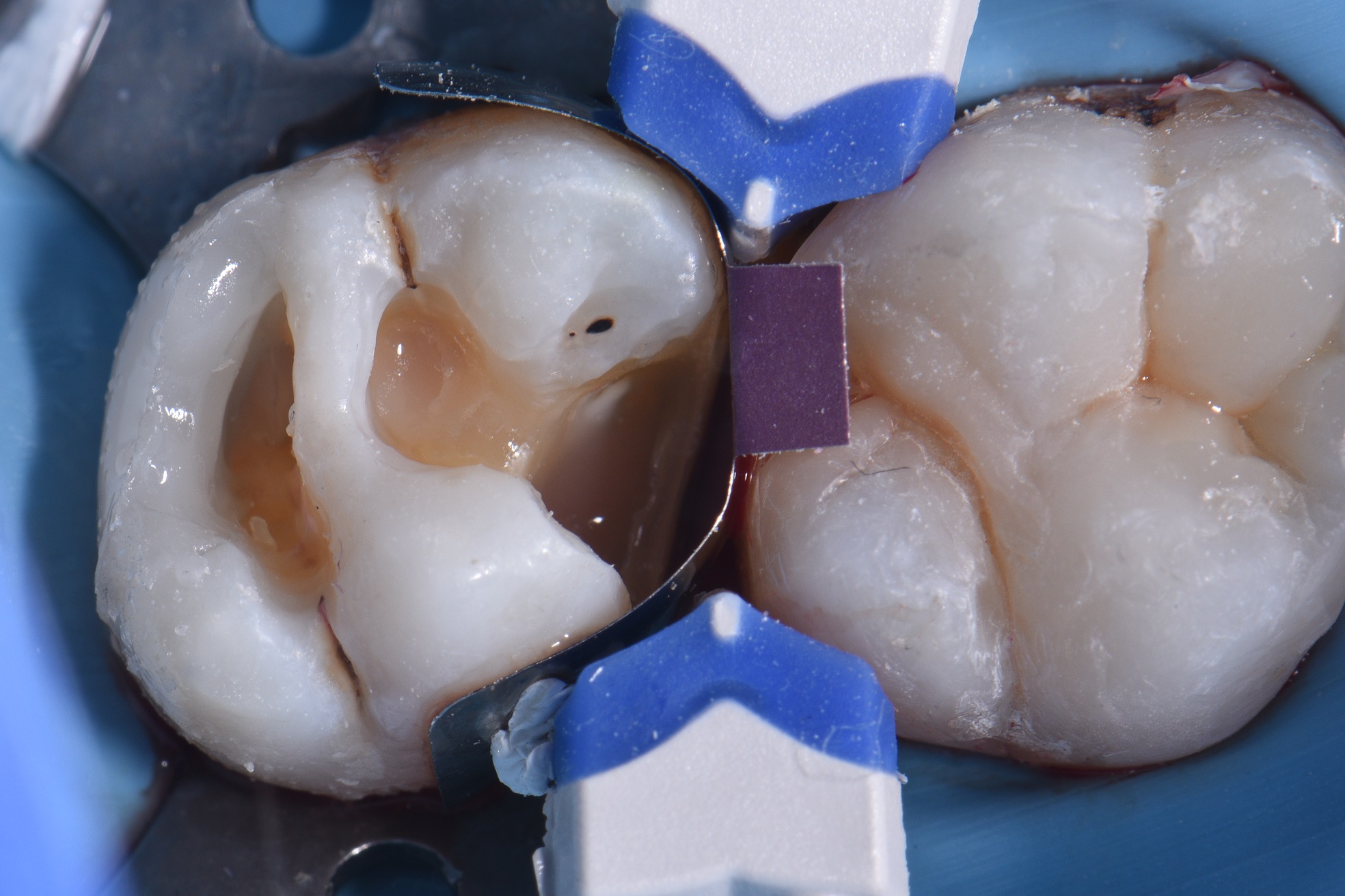 Large Fillings | Sculpted Composite Resin Artistry | Auckland Dentist