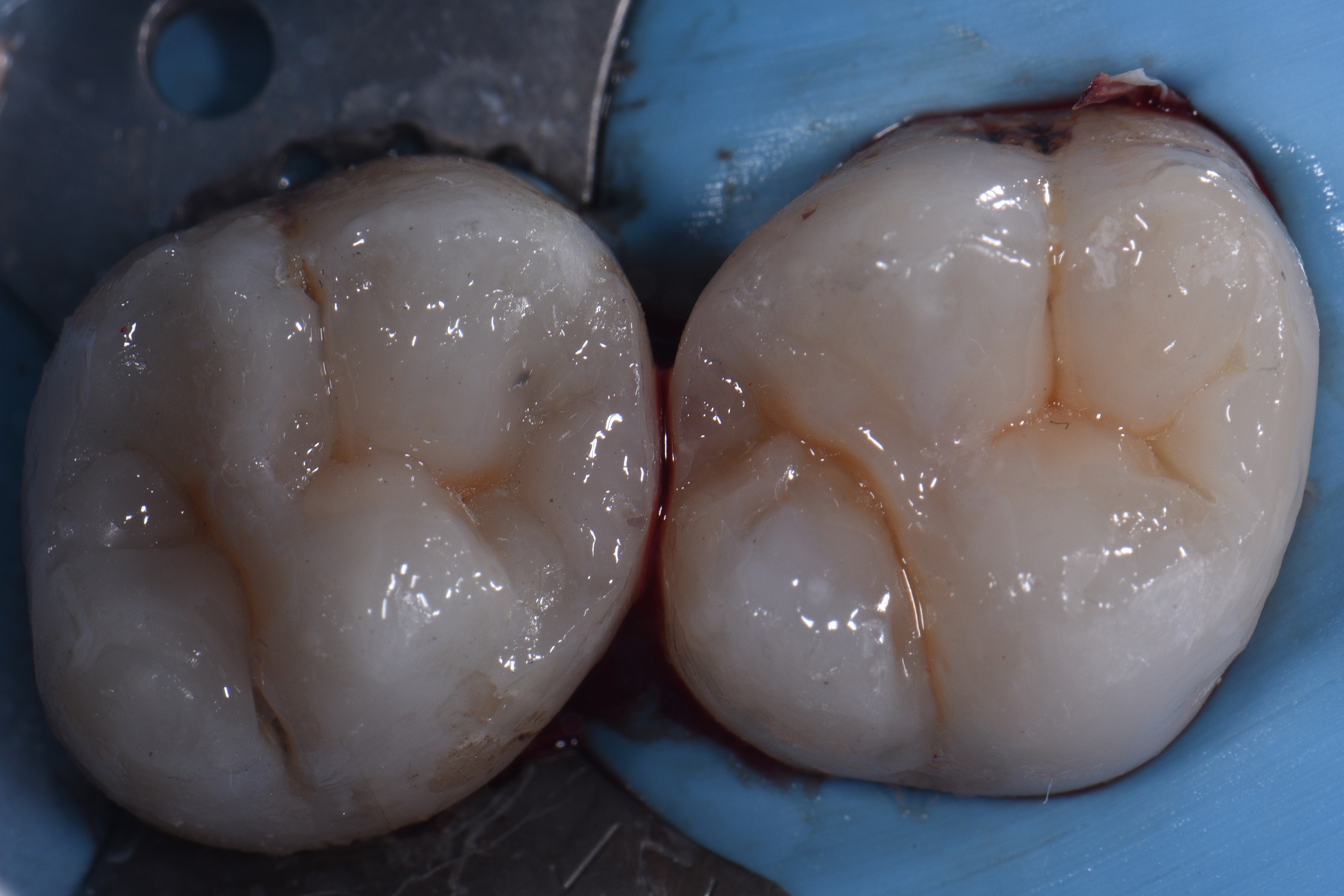 Large Fillings | Sculpted Composite Resin Artistry | Auckland Dentist