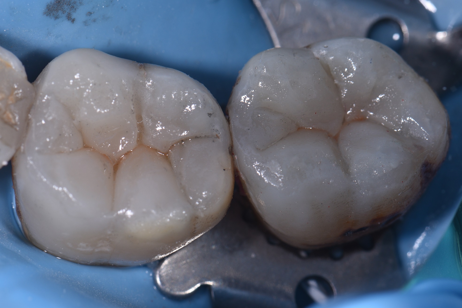 Super Bulk Fill Technique | Restorative Dentistry Auckland | Tam Dental ...