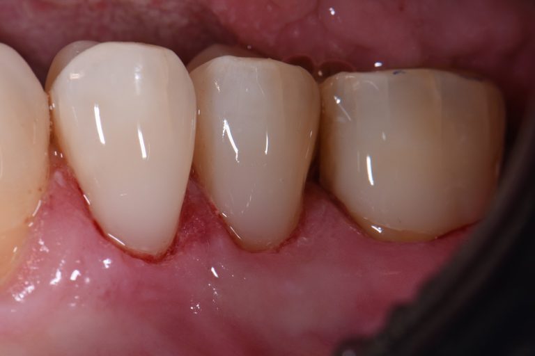 Cervical Abrasion | Toothbrush Abrasion | Restorative Dentistry ...