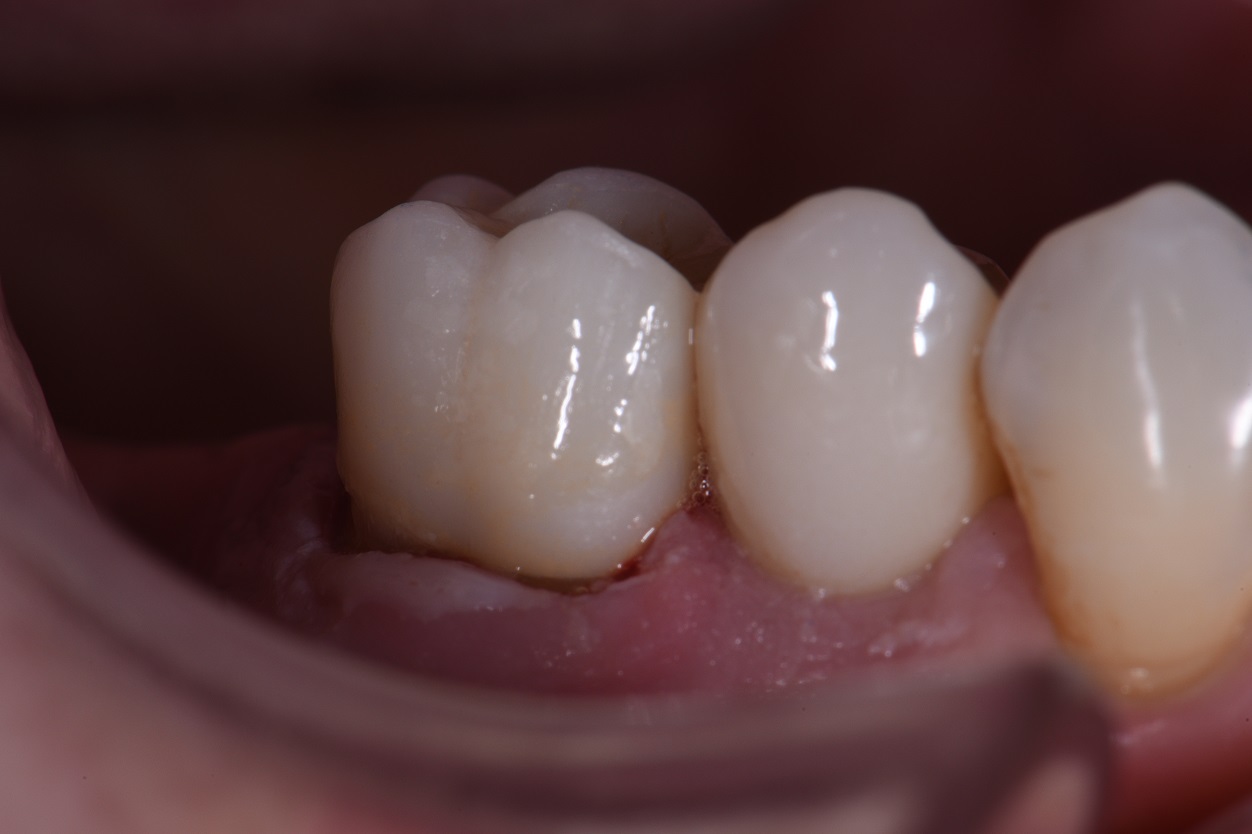 Beautiful Lithium Disilicate Crowns | Restorative Dentist Auckland