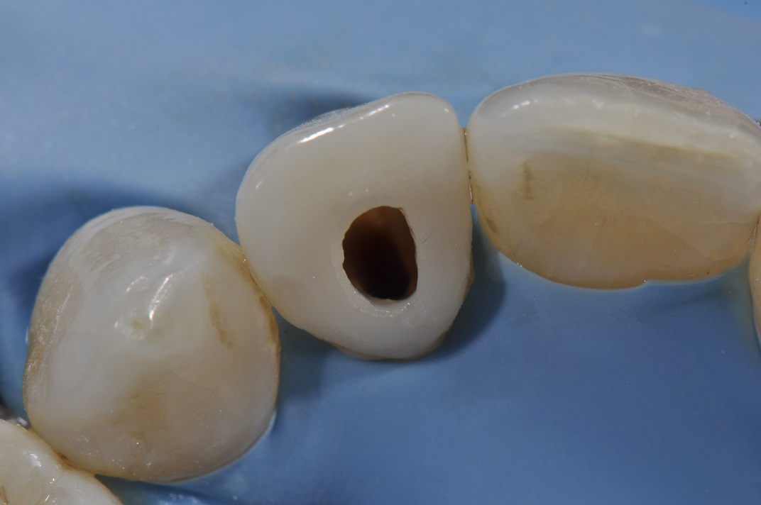 Advanced Root Canal Post System | Rebilda GT Post by Voco