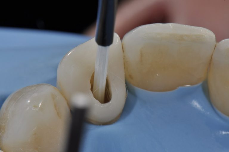 Advanced Root Canal Post System | Rebilda GT Post by Voco