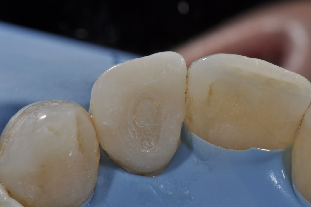 Advanced Root Canal Post System | Rebilda GT Post by Voco