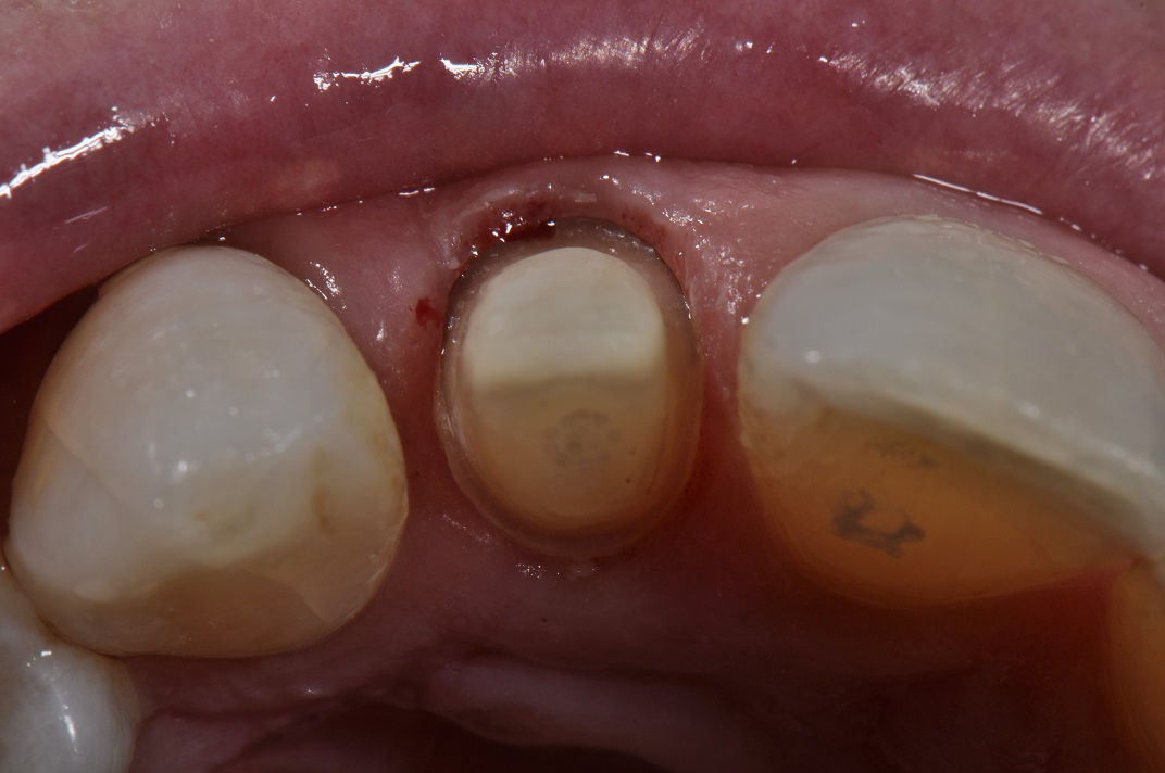 Advanced Root Canal Post System | Rebilda GT Post by Voco