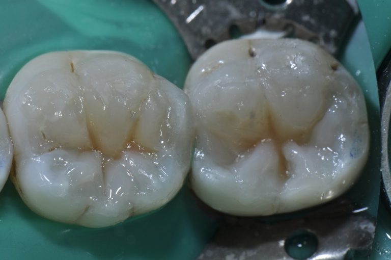 Injectable Composite Layering | GC G-Aenial Universal Flowable Injectable