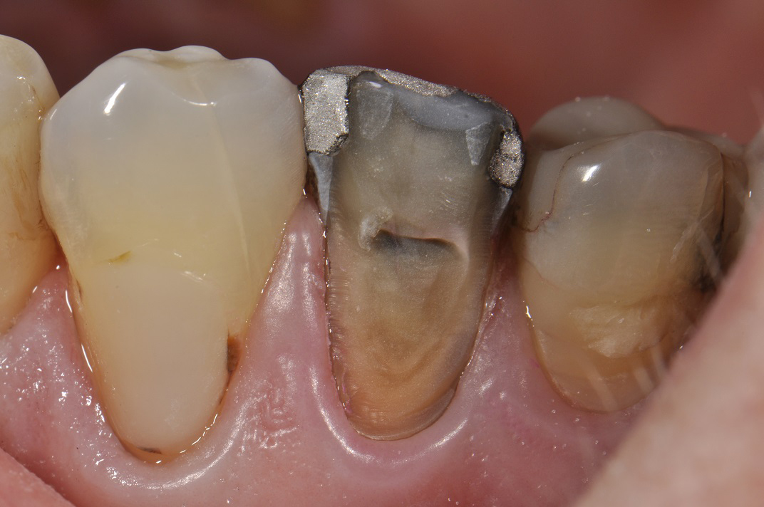 The Power of Composite – Pushing the Limits of Esthetic Possibility