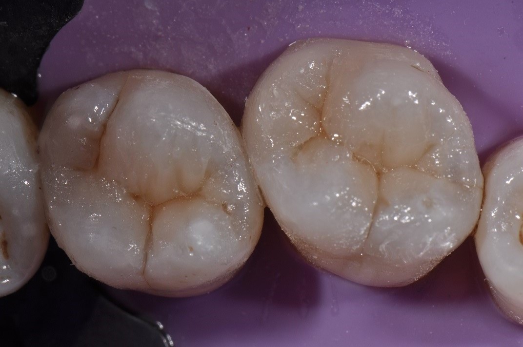 Restoring Broken Teeth with Beautiful Composite Resin | Tam Dental ...