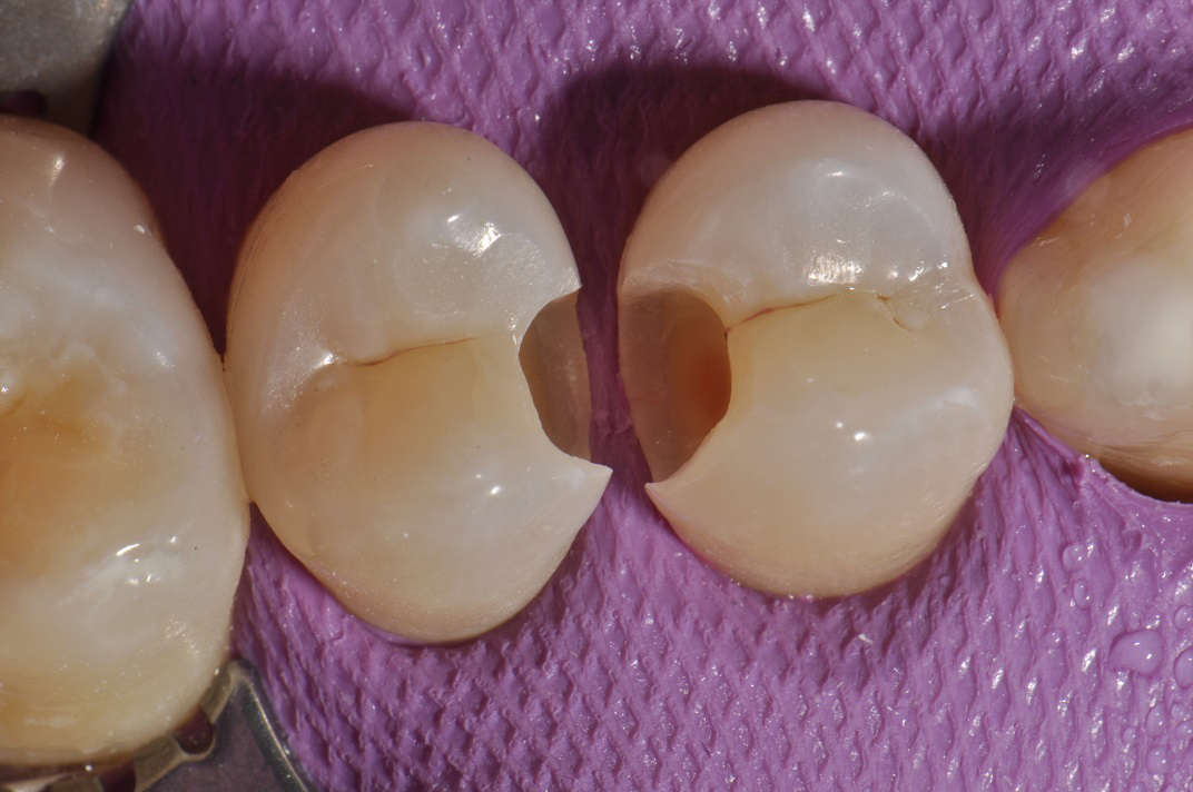 The Actual Extent of a Grade 3 (R3) Carious Lesion (Cavity)
